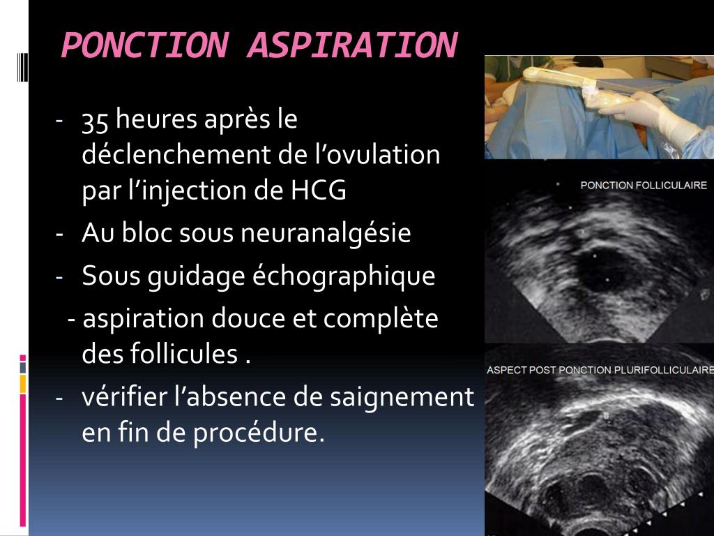 PPT - PLACE DE L’ECHOGRAPHIE AU COURS DE LA PROCREATION MEDICALEMENT ...