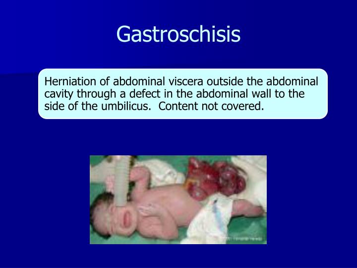 PPT - Nursing Care of the Child with Gastrointestinal Disorders ...