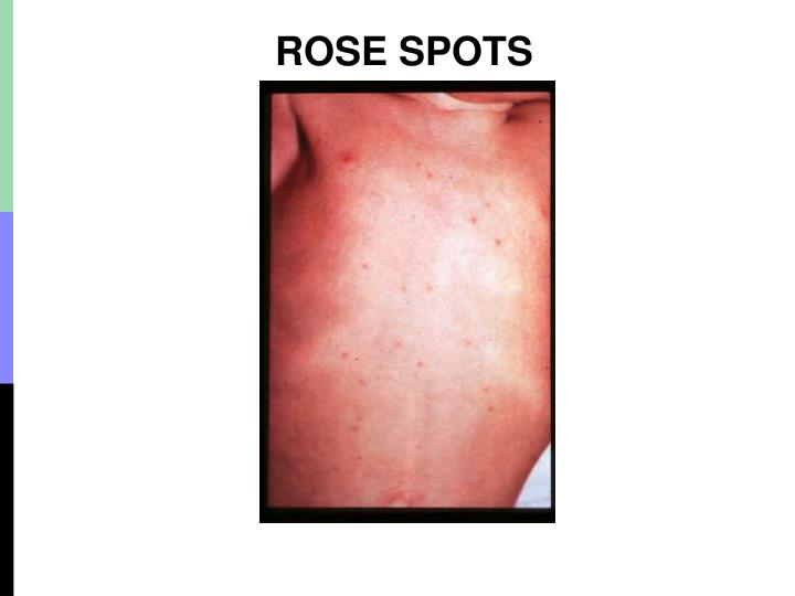 Salmonella Typhi Rose Spots