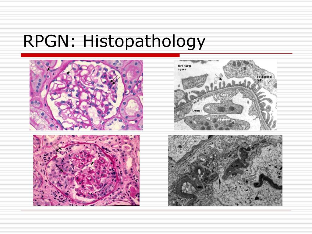 PPT - Anti-Glomerular Basement Membrane Disease PowerPoint Presentation ...