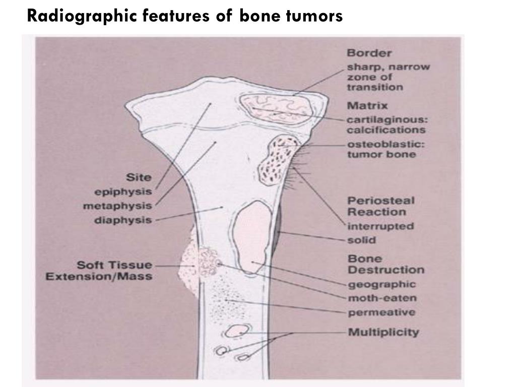 PPT - Primary bone tumors presenter: ondari n.j FACILITATOr : prof ...