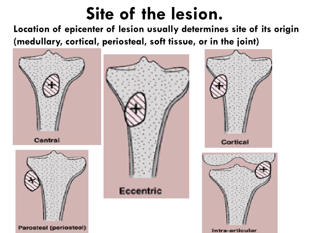 PPT - Primary bone tumors presenter: ondari n.j FACILITATOr : prof ...