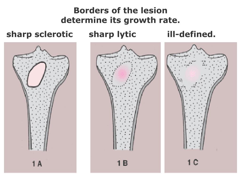 PPT - Primary bone tumors presenter: ondari n.j FACILITATOr : prof ...