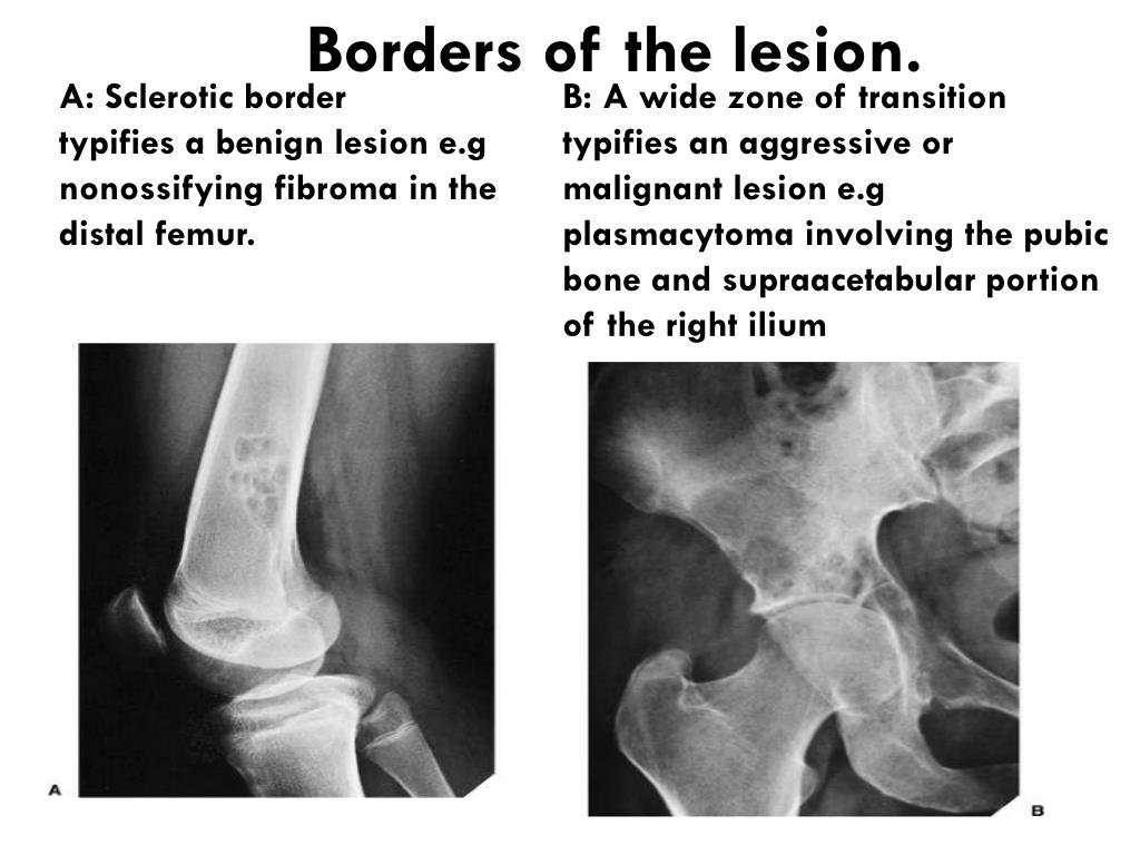 PPT - Primary bone tumors presenter: ondari n.j FACILITATOr : prof ...