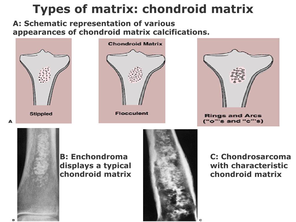 PPT - Primary bone tumors presenter: ondari n.j FACILITATOr : prof ...