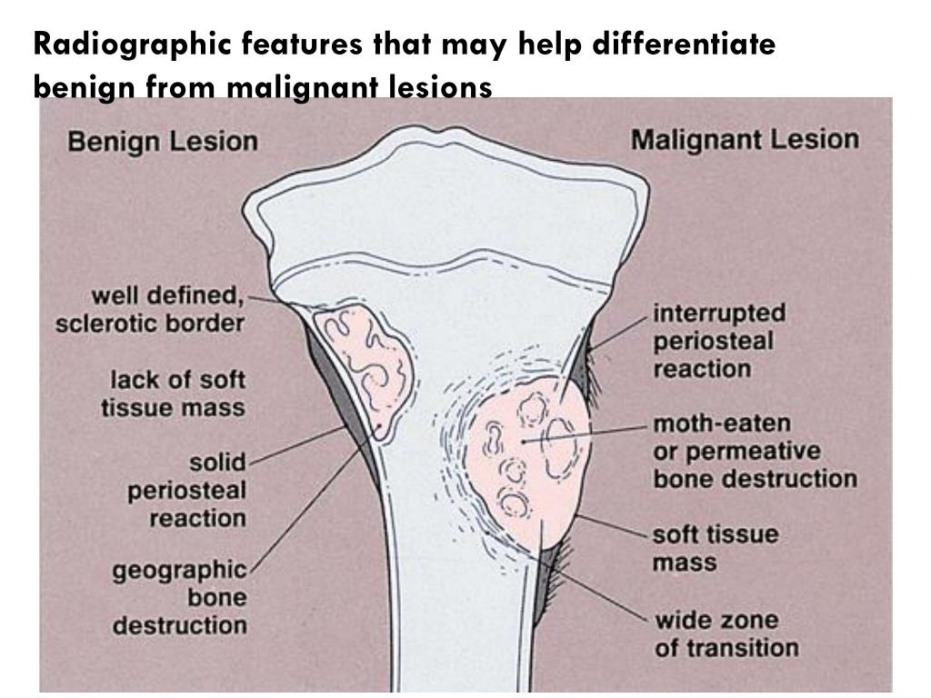 PPT - Primary bone tumors presenter: ondari n.j FACILITATOr : prof ...