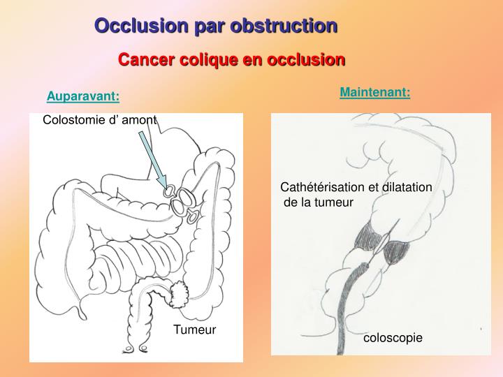 PPT - DOULEUR ABDOMINALE PowerPoint Presentation - ID:3304160