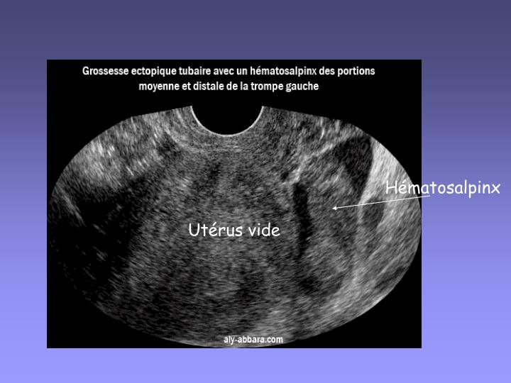 PPT - Grossesse Extra-Utérine PowerPoint Presentation - ID:3304347