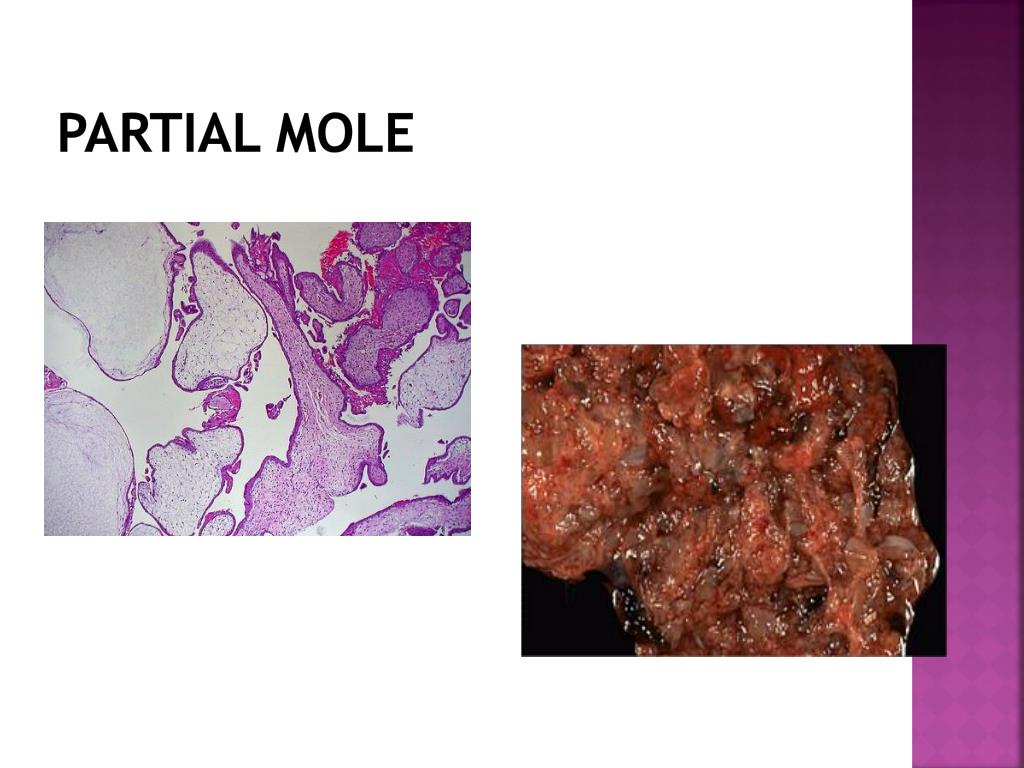 PPT - Gestational trophoblastic disease dr.maryam bakir fibogo-dgo ...