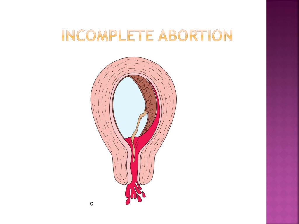 PPT - HIGH RISK ANTEPARTUM NURSING CARE PowerPoint Presentation, free ...