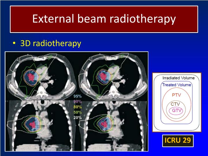 PPT - The external beam radiotherapy and Image-guided radiotherapy (1 ...