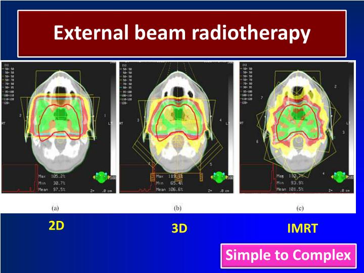 PPT - The external beam radiotherapy and Image-guided radiotherapy (1 ...
