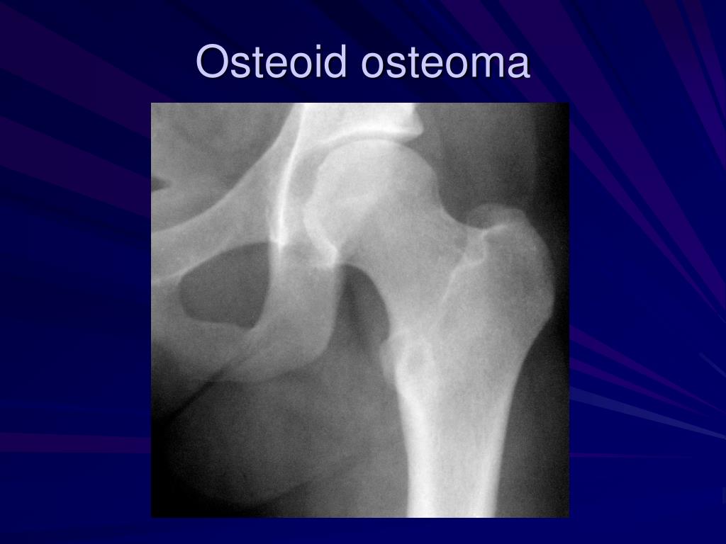 PPT - Współczesna diagnostyka obrazowa nowotworów układu kostno ...