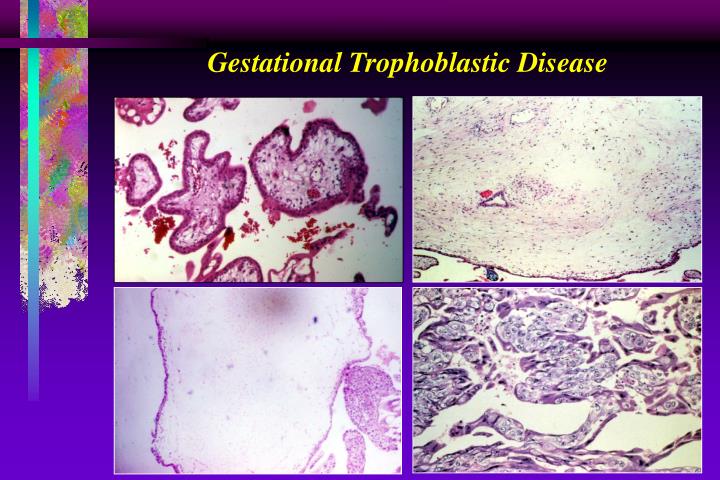 PPT - Gestational Trophoblastic Disease PowerPoint Presentation - ID ...