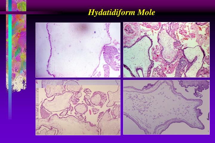 PPT - Gestational Trophoblastic Disease PowerPoint Presentation - ID ...