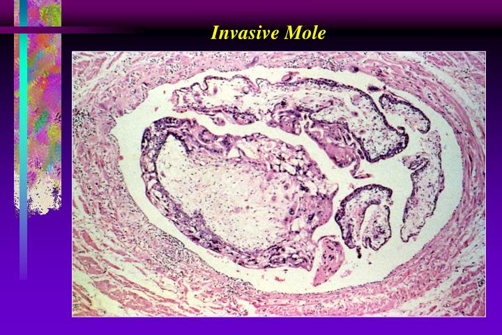 PPT - Gestational Trophoblastic Disease PowerPoint Presentation - ID ...