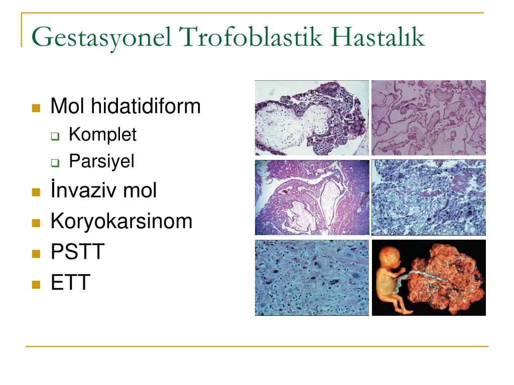 PPT - Gestasyonel Trofoblastik Hastalıkta Tedavi-Monitorizasyon ...