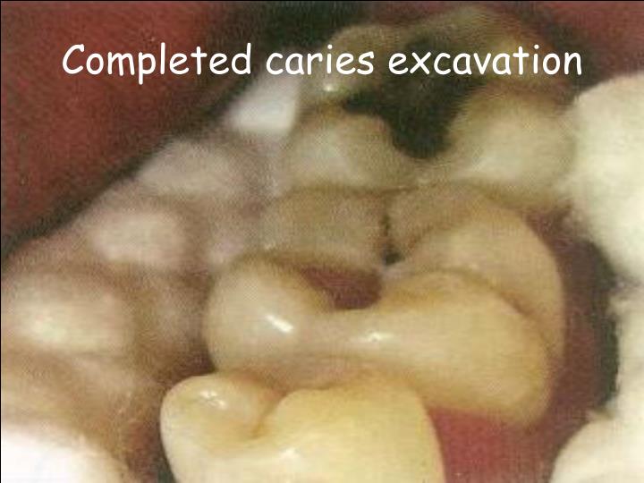 PPT - GLASS IONOMER CEMENTS PowerPoint Presentation - ID:3307200