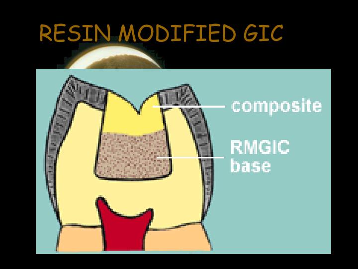 PPT - GLASS IONOMER CEMENTS PowerPoint Presentation - ID:3307200