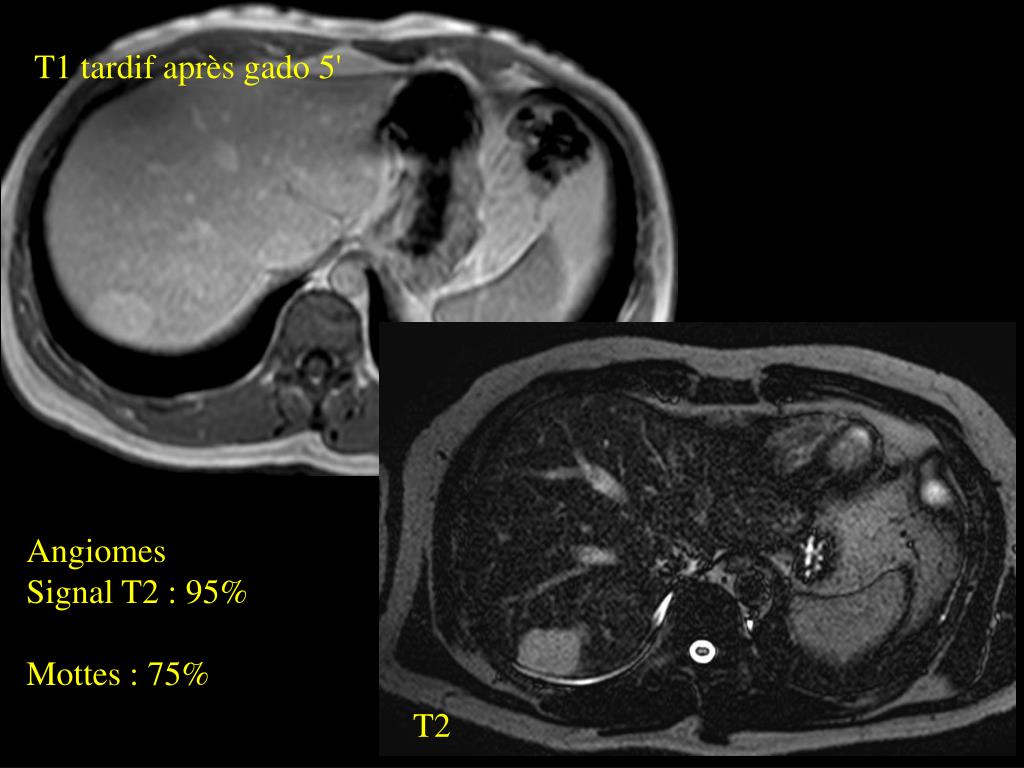 PPT - SEMEIOLOGIE DES TUMEURS DU FOIE O. ERNST oernst/fac/ PowerPoint ...