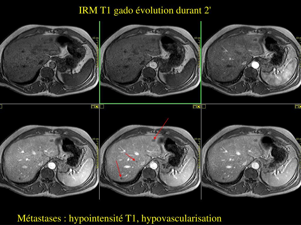 PPT - SEMEIOLOGIE DES TUMEURS DU FOIE O. ERNST oernst/fac/ PowerPoint ...
