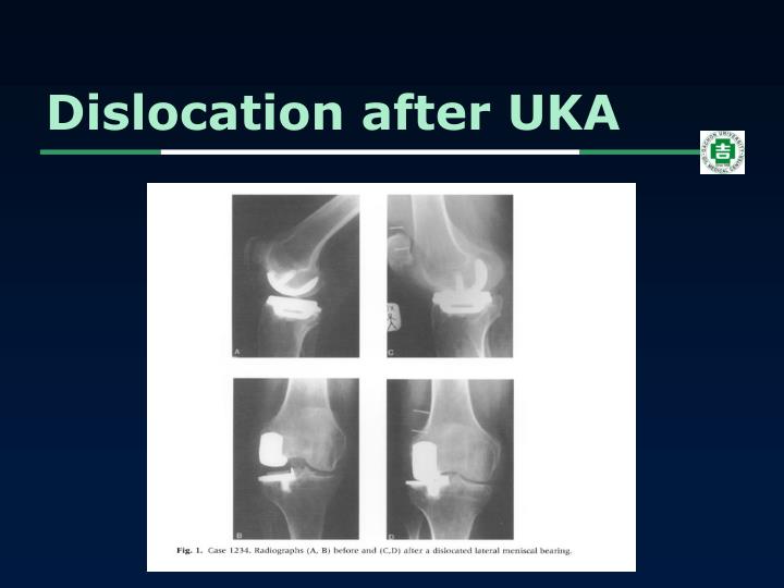 PPT - Operation of Arthritic Knee - HTO vs UKA - PowerPoint ...