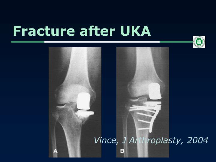 PPT - Operation of Arthritic Knee - HTO vs UKA - PowerPoint ...