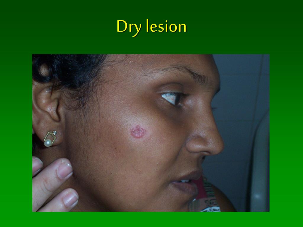 PPT - Understanding Diseases in Brazil: Leishmaniasis, Chagas, and ...