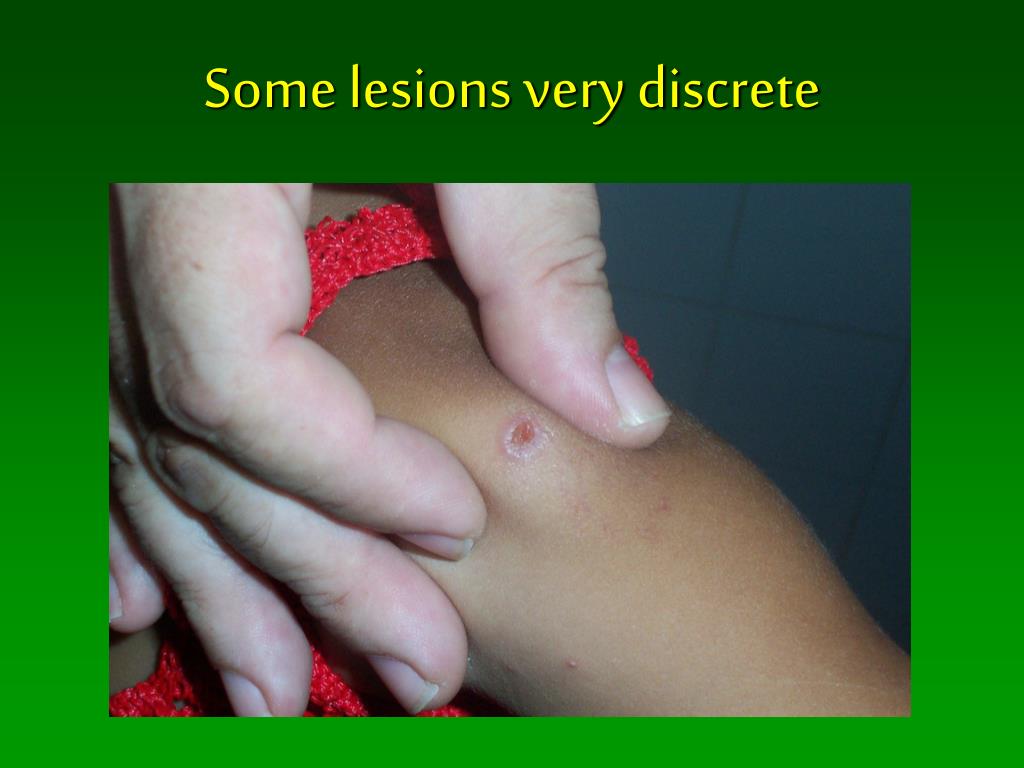 PPT - Understanding Diseases in Brazil: Leishmaniasis, Chagas, and ...