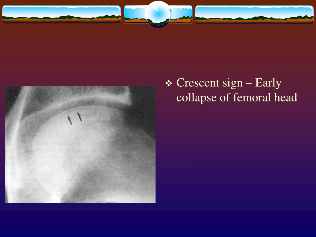 PPT - AVN of the Femoral Head PowerPoint Presentation, free download ...