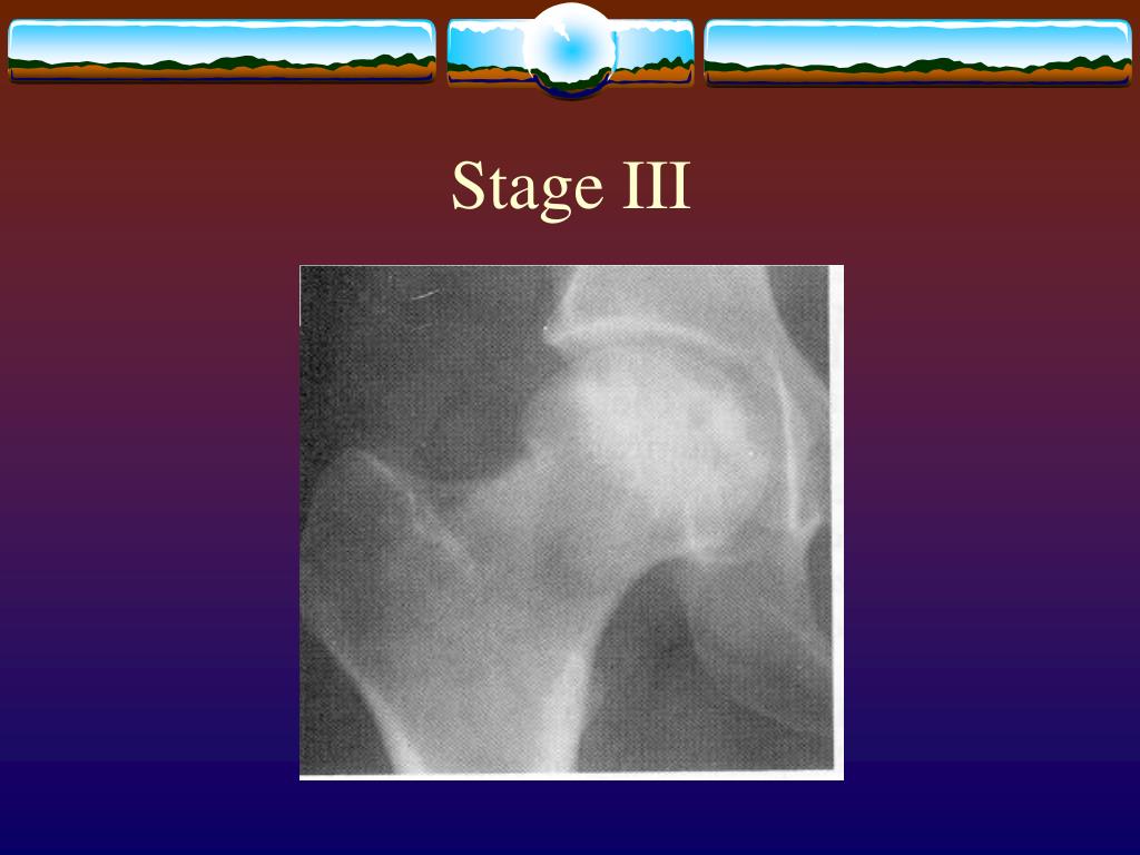 PPT - AVN of the Femoral Head PowerPoint Presentation, free download ...