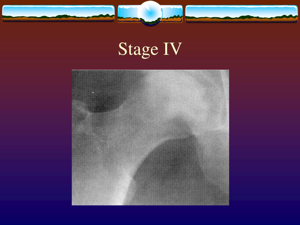 PPT - AVN of the Femoral Head PowerPoint Presentation, free download ...