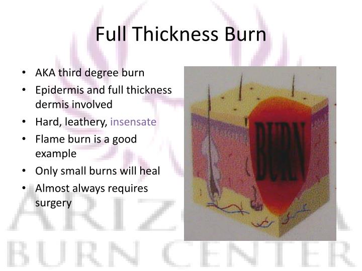 PPT - Burns in the Emergency Department PowerPoint Presentation - ID ...