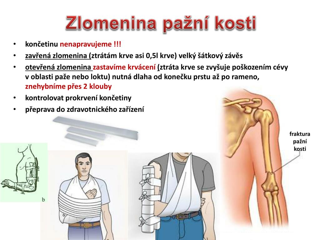 PPT - PRVNÍ POMOC PŘI ZLOMENINÁCH HORNÍCH A DOLNÍCH KONČETIN PowerPoint ...
