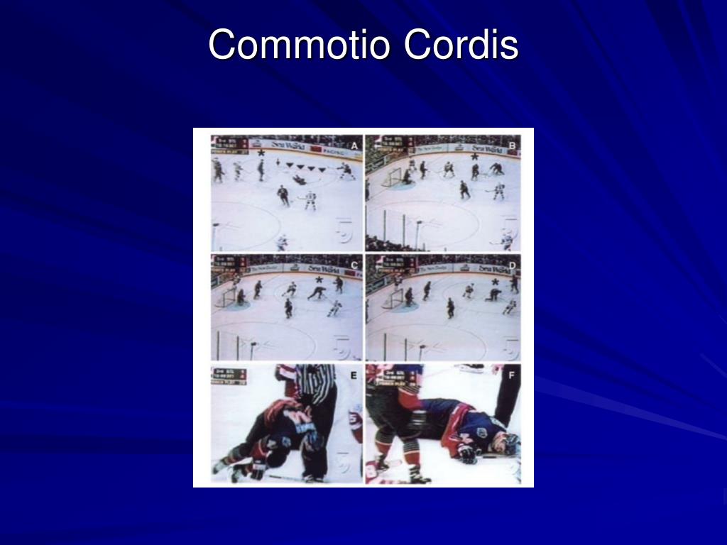 PPT - Cardiac Pathology in Athletes: Sudden Death in Young People ...