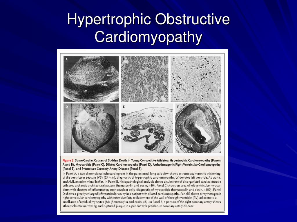 PPT - Cardiac Pathology in Athletes: Sudden Death in Young People ...