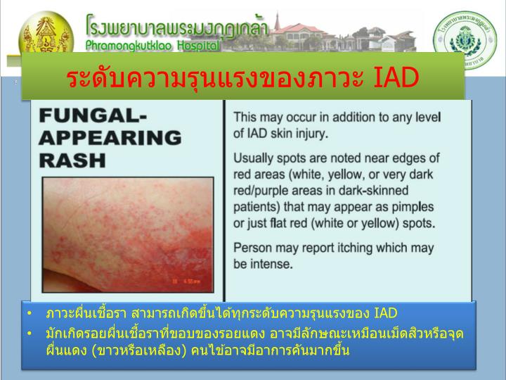 PPT - Incontinence-Associated Dermatitis ( IAD ) PowerPoint ...