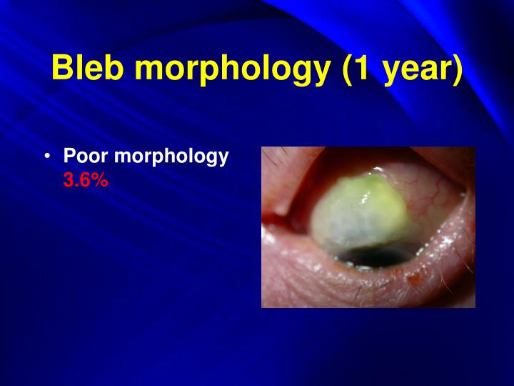 PPT - Trabeculectomy + MMC Audit PowerPoint Presentation - ID:3318928