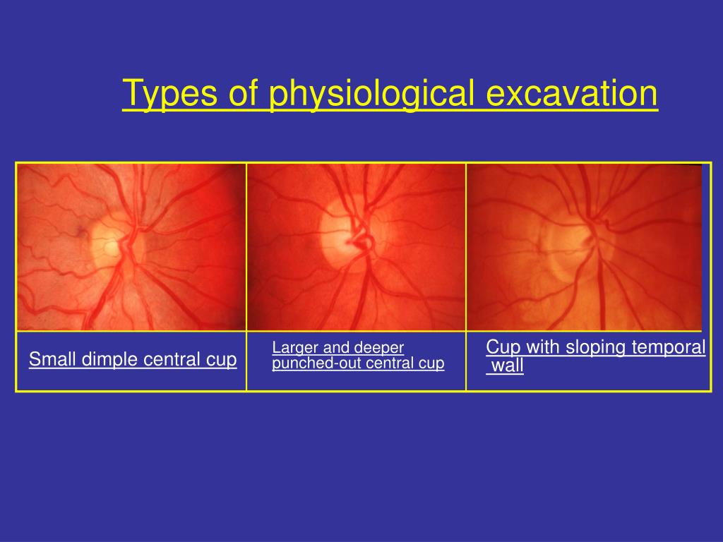 PPT - DR.K.SUDHAMATHI CONSULTANT EYEQ SUPERSPECIALITY HOSPITALS ...