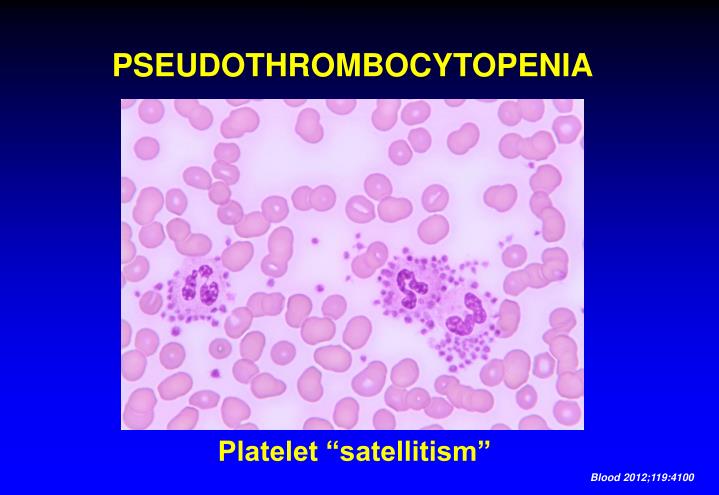 PPT - THROMBOCYTOPENIA PowerPoint Presentation - ID:3319204