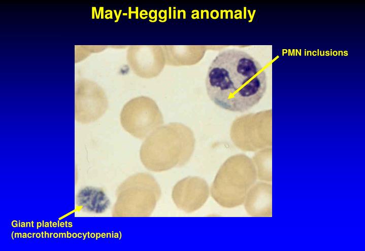 PPT - THROMBOCYTOPENIA PowerPoint Presentation - ID:3319204