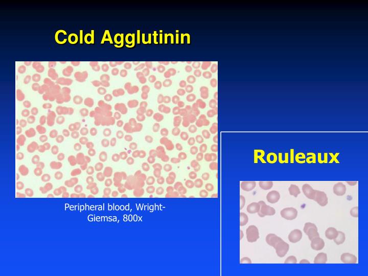 PPT - Autoimmunity in Chronic Lymphocytic Leukemia PowerPoint ...