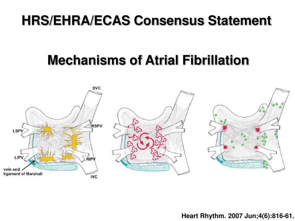 PPT - HRS/EHRA/ECAS Consens us Statement on Catheter and Surgical ...