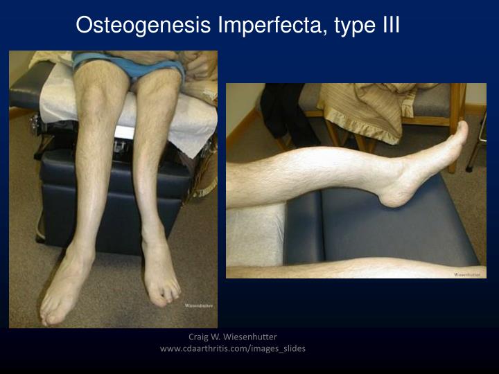 PPT - Genetic Collagen Disorders Osteogenesis Imperfecta Ehlers Danlos ...