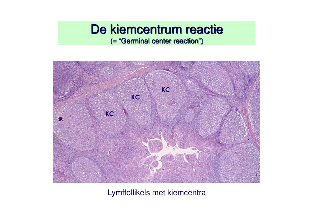 PPT - Folliculair non-Hodgkin Lymfoom Blok oncologie, April 2012 ...