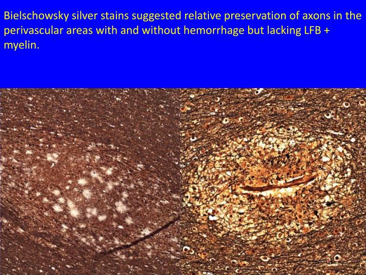 PPT - AMERICAN ASSOCIATION OF NEUROPATHOLOGISTS 51ST ANNUAL DIAGNOSTIC ...