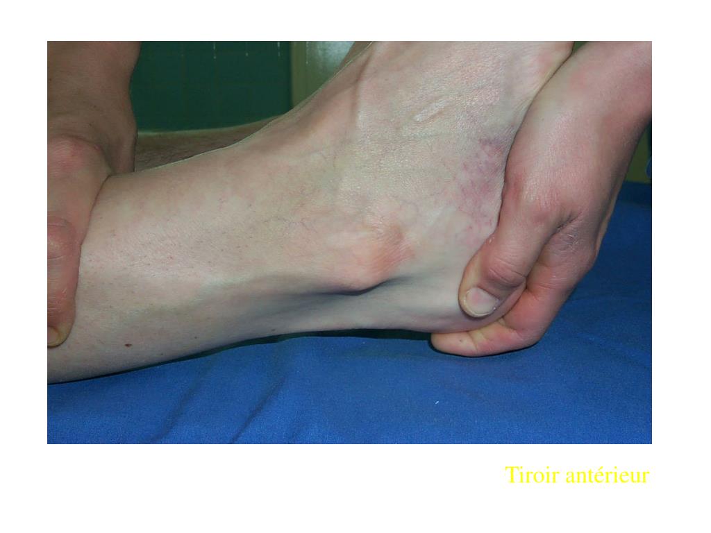 PPT - ENTORSE DU LLE DE LA CHEVILLE PowerPoint Presentation, free ...