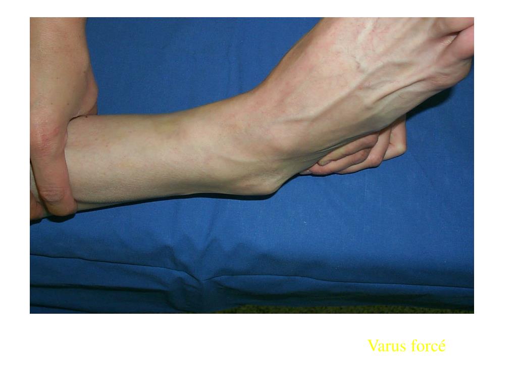 PPT - ENTORSE DU LLE DE LA CHEVILLE PowerPoint Presentation, free ...