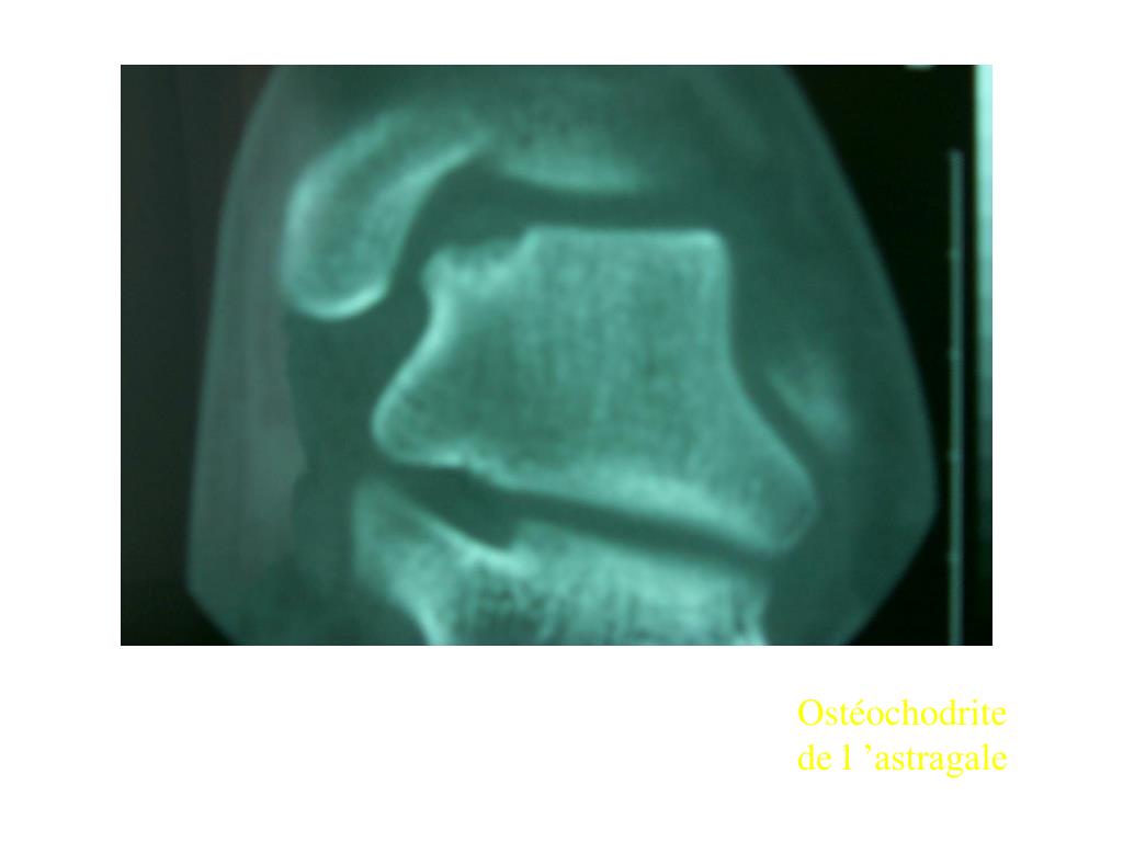 PPT - ENTORSE DU LLE DE LA CHEVILLE PowerPoint Presentation, free ...