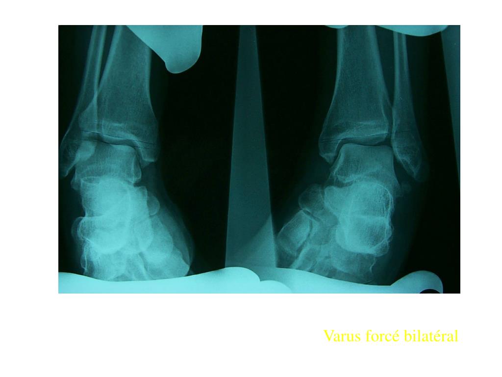 PPT - ENTORSE DU LLE DE LA CHEVILLE PowerPoint Presentation, free ...